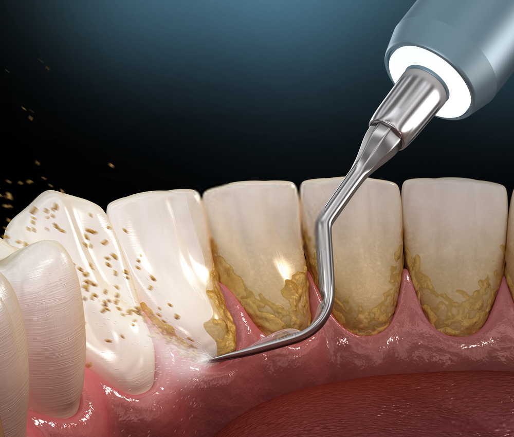 calculo dentario - Dentista Porto Alegre - Zona Norte - Hera ...