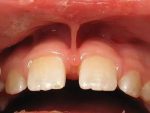 Freio Labial Superior - Dentista Porto Alegre - Zona Norte - Hera ...
